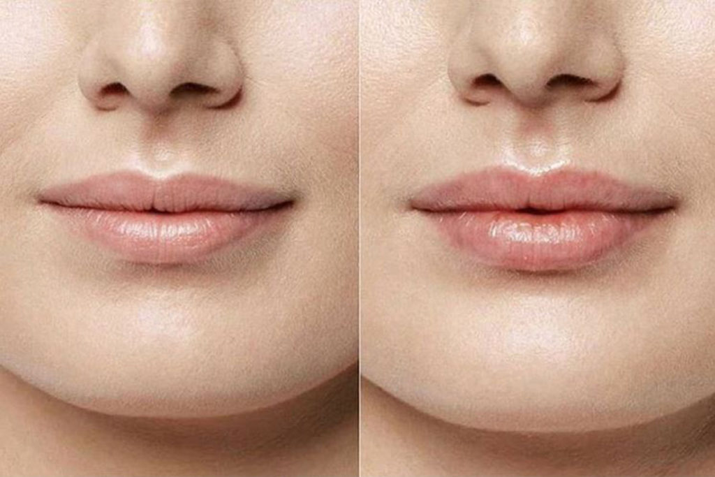 What is the Hyaluron Pen: everything you need to know